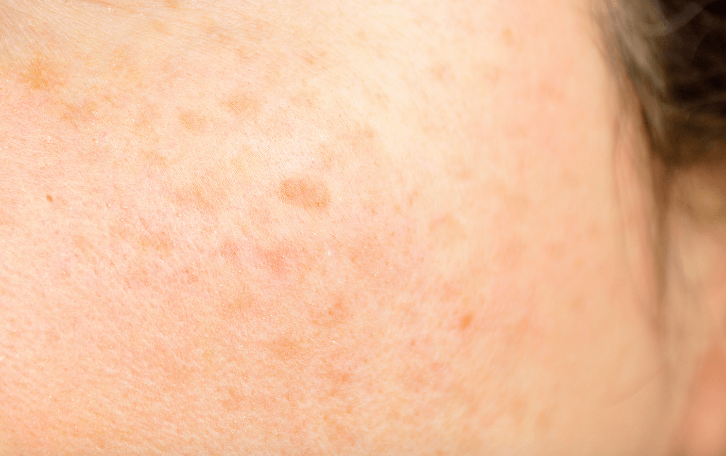 Sun Spots: What Are They & How to Treat Them - Joanna Czech
